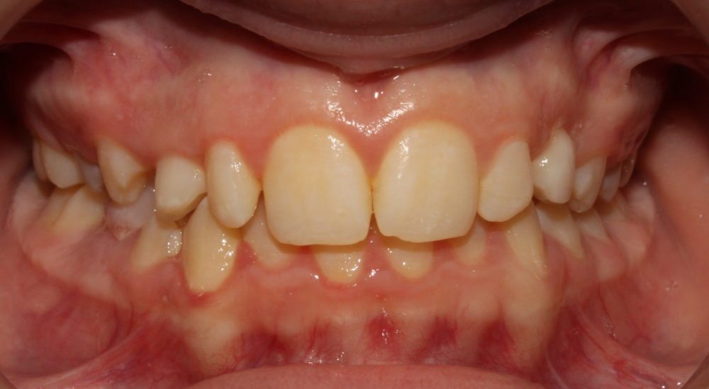 impacted tooth pic 1A - Prettyman Orthodontics