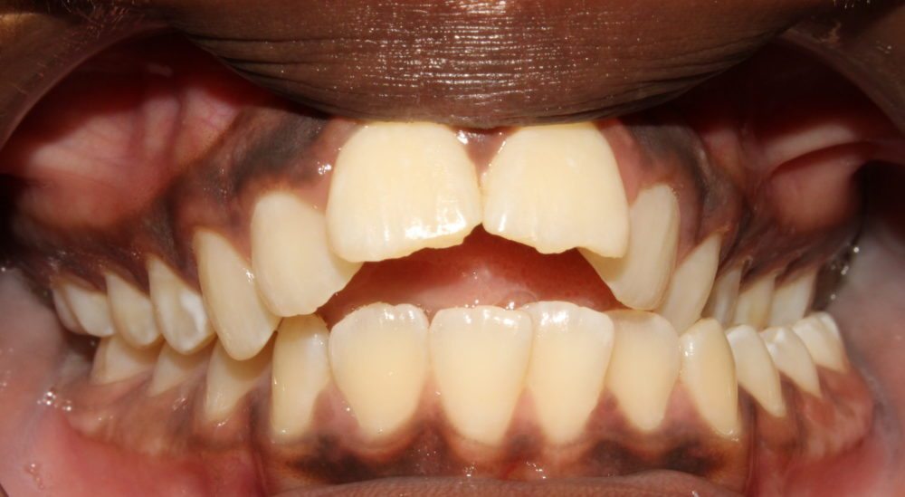 open bite.habit - Prettyman Orthodontics