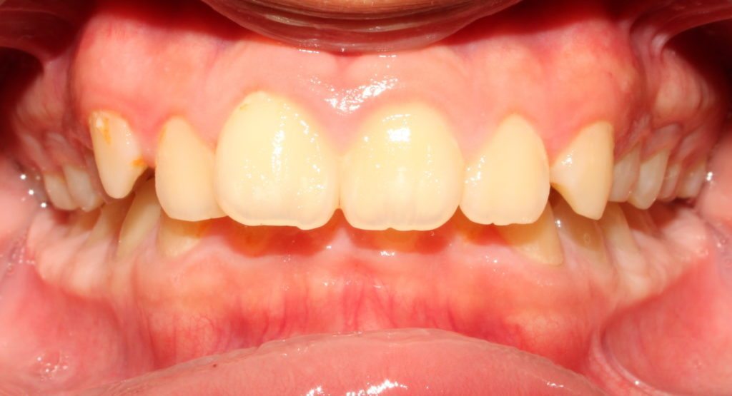 overbite - Prettyman Orthodontics